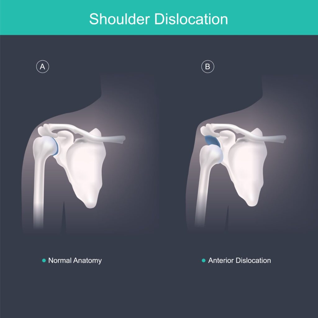 Shouldering Your Dislocation Pain | Orthopaedic Associates of Duluth